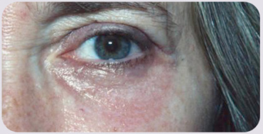 Cosmetic Surgery – Silkiss Eye Surgery